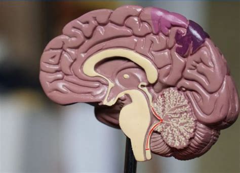 Infarto cerebral es la segunda causa de discapacidad en México Voz en Red