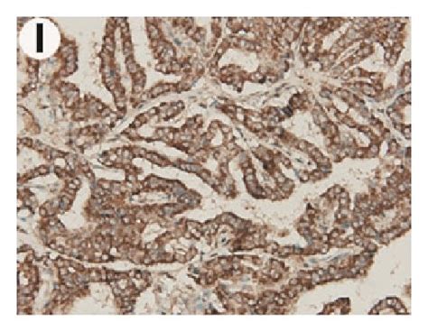 Immunohistochemical staining for HIF 2α TWIST and CXCR4 Columns