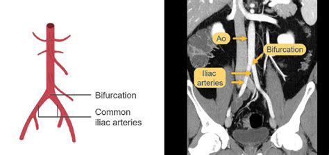 Abdominal CT Abdominal Arteries LITFL Radiology Library