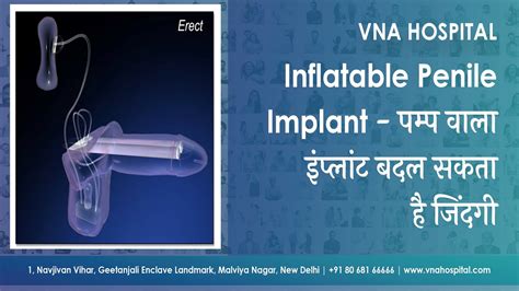 Inflatable Penile Implant For Ed पम्प इम्प्लांट बदल सकता है ज़िन्दगी