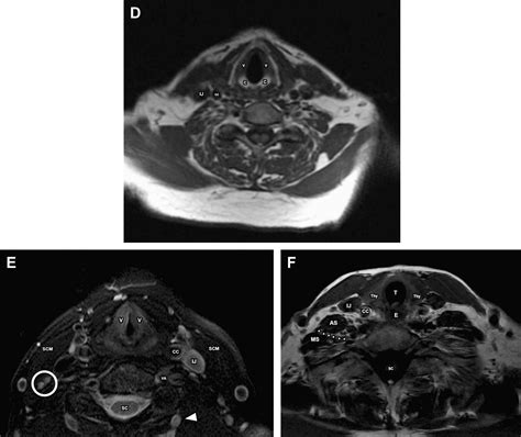 Neck Mr Imaging Anatomy Magnetic Resonance Imaging Clinics