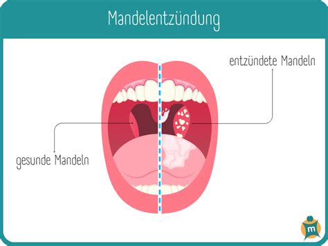 Angina Mandelentz Ndung Ihre Apotheke Informiert