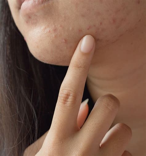 Como Tirar Manchas De Espinha Do Rosto Beleza Na Web