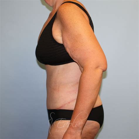 Fleur De Lis Tummy Tuck Archives Evolve Aesthetic Surgery