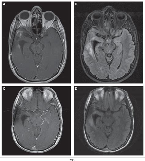 Figure 1 From Successful Treatment Of A Progressive BRAF V600E Mutated