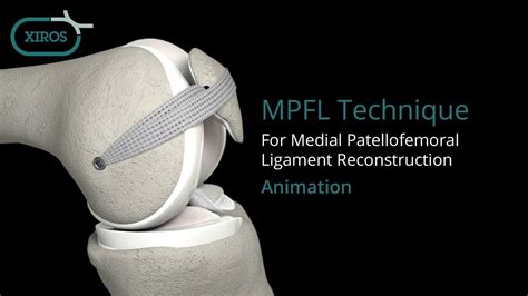 MPFL Technique Using A 10 X 500 Mm Poly Tape Animation YouTube