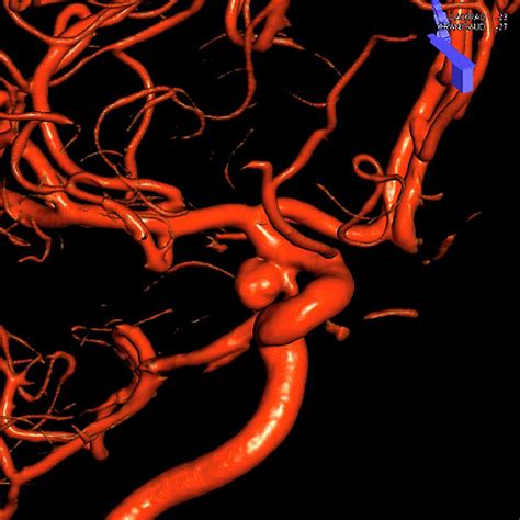 Brain Aneurysm Photograph By Zephyr Science Photo Library Pixels