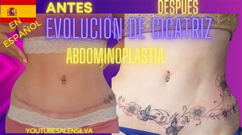 EVOLUCIÓN DEL REPARO CORRECCION DE CICATRIZ DE ABDOMINOPLASTIA ABDOMEN