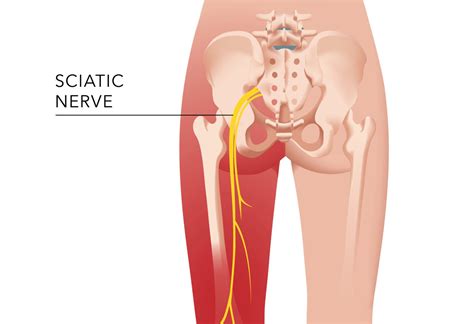Buttock Pain Causes Best Treatment Options In 2024