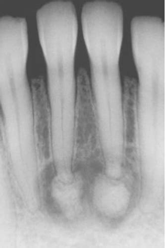 Oral Pathology Non Neoplastic Disease Of Bone Flashcards Quizlet