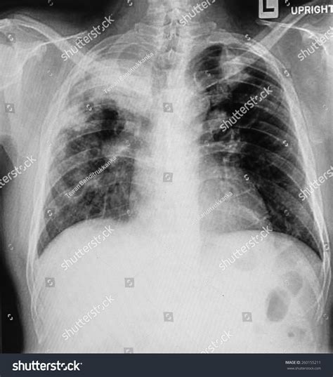 Pulmonary Tuberculosis Chest Xray Right Lung Stock Photo