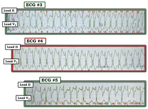 Dr Smith S ECG Blog Chest Discomfort Sinus Tachycardia Q Waves ST