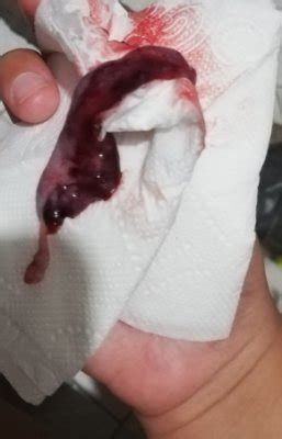 Aborto Espont Neo Babycenter