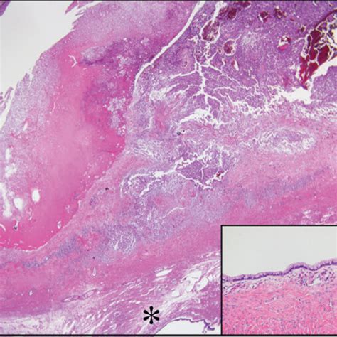 Microcystic Stromal Tumor Mst Of The Ovary A Solid Nodule With
