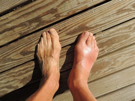 Por qué se hinchan los pies Causas y recomendaciones Clínica Guinova
