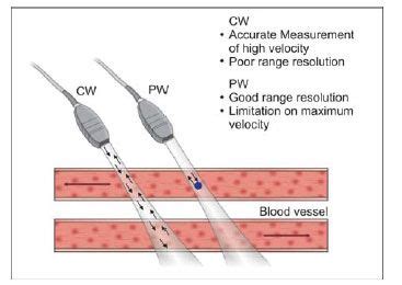 Continous Wave Vs Pulsed Wave Vascular Ultrasound Ultrasound