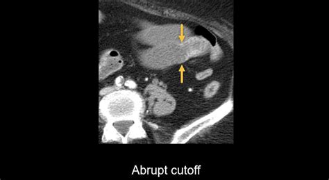 Abdominal Ct Intestinal Ischaemia Litfl Radiology Library