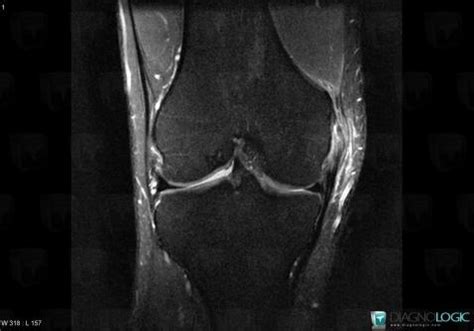 Radiology Case Medial Collateral Ligament Rupture Mri Diagnologic