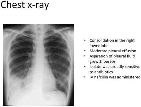 Solved Chest X Ray Consolidation In The Right Lower Lobe Moderate