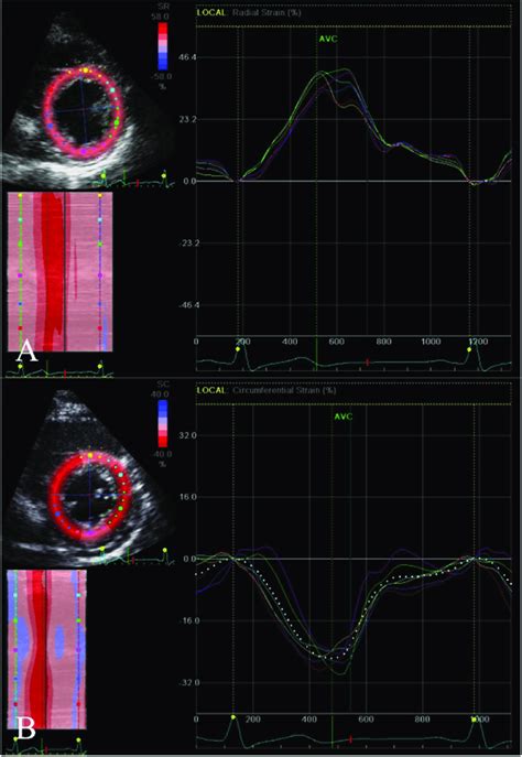 Radial And Circumferential Strain A Radial Strain Peak Systolic