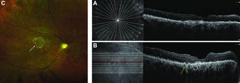 OCT Findings In Geographic Atrophy Age Related Macular Degeneration A