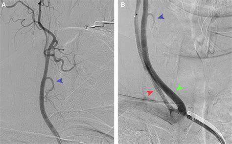 Stroke AHA ASA On Twitter Stroke Images Navigating An Internal
