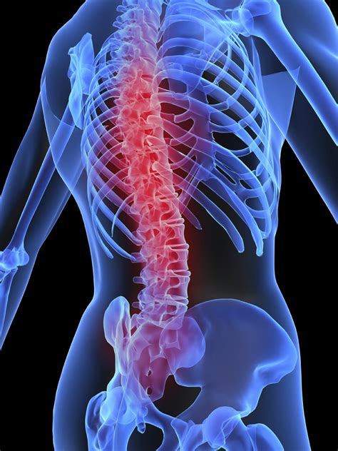 Artrosis De Columna S Ntomas Y Tratamiento Dolor De Espalda Y Cuello