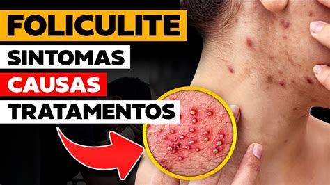FOLICULITE CAUSAS SINTOMAS TRATAMENTOS YouTube