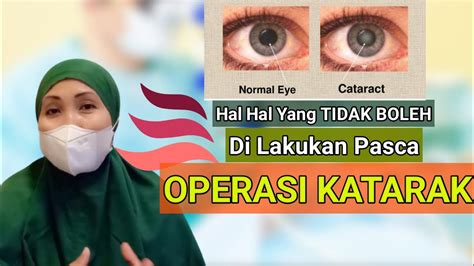Perawatan Katarak Homecare24