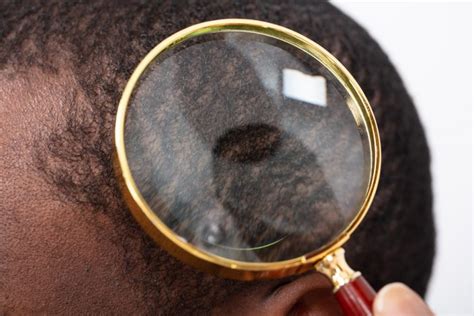 Infection Après Greffe de Cheveux Causes Risques Traitement