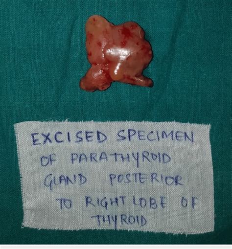 Specimen Of 3x2 5x1 Cm Sized Excised Adenoma Of The Parathyroid Gland