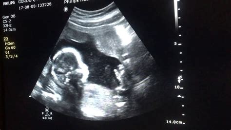 How To Get Your Baby To Move For An Ultrasound Baby Viewer