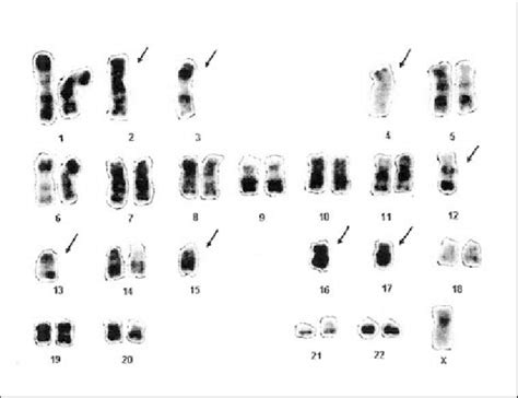 G Banded Male Karyotype In ALL Patient Showing Multiple Whole