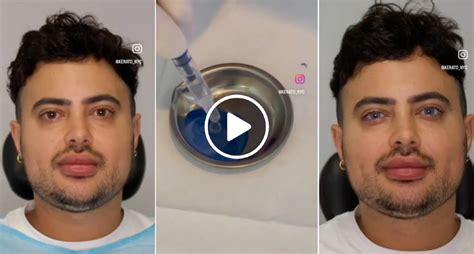 Procedimento Estético De Mudança Da Cor Dos Olhos Em Pacientes Torna se