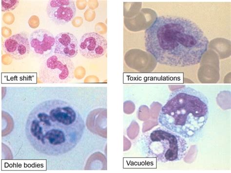 Wbc And Thrombocyte Disorders Flashcards Quizlet