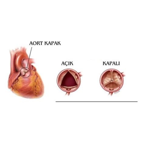 Aortic Valve Surgery Prof Dr Tayfun Aybek