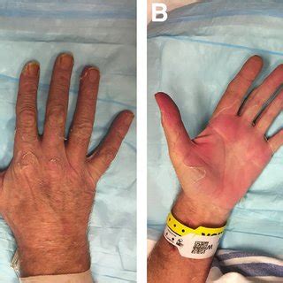 Toxic Shock Syndrome Rash On Palms