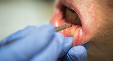 New Video Shows How To Perform A Lip Biopsy To Diagnose Sjögrens Syndrome The Rheumatologist