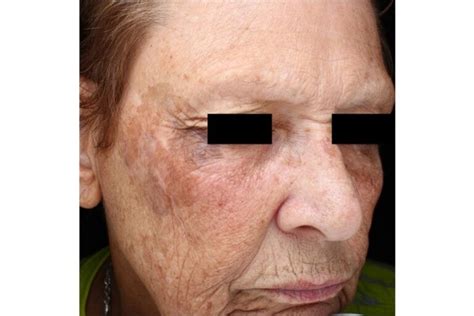 Traitement des taches brunes au laser à Paris Dermatologue Skin Marceau