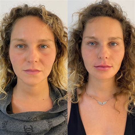 Especialista Explica Como Funciona A Revers O De Harmoniza O Facial