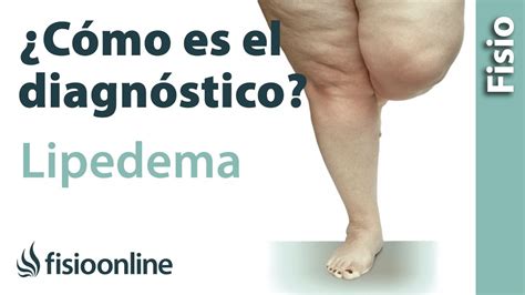 Cómo SABER si tengo LIPEDEMA signos y síntomas para el DIAGNÓSTICO