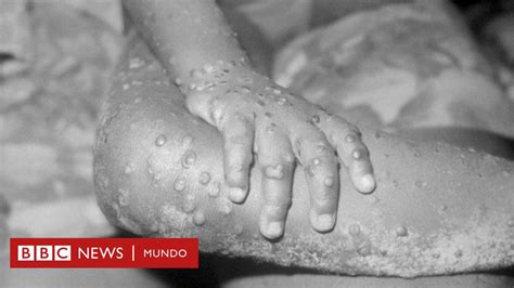 Coronavirus la viruela la única enfermedad humana que ha sido