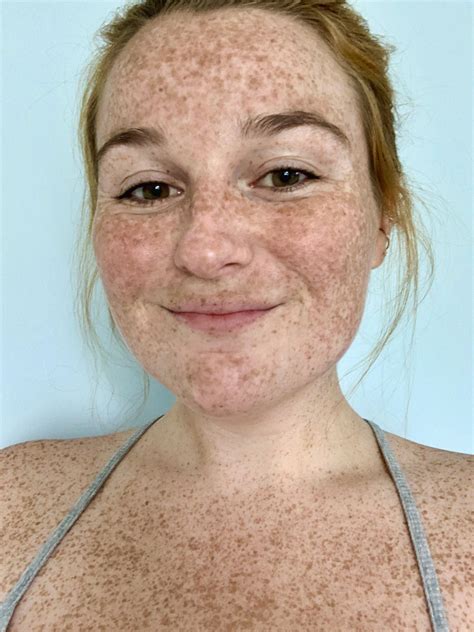 Tons Of Freckles