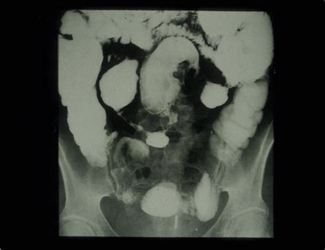 Gastroenterology Ibd Flashcards Quizlet