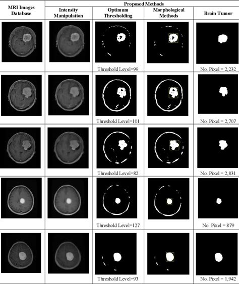 the automatic brain tumor segmentation based on mri using optimal morphology thresholding