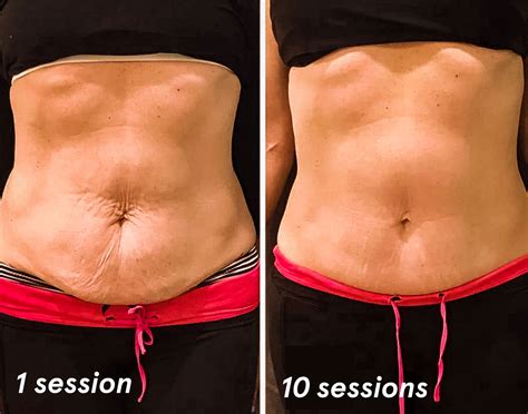 Body Sculpting Treatments In Allen Body Sculpt Session 972 630 4257