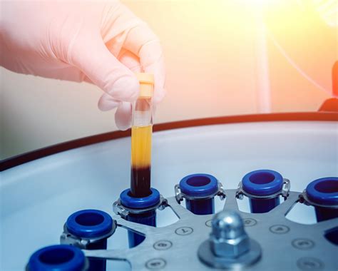 Plasmapheresis As An Effective Therapy For NMOSD MS And MG