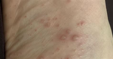 What Are These Small Bumps On My Feet Printable Templates Free