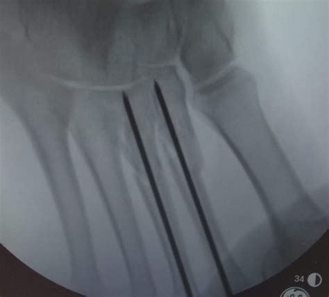Figure An X Ray Of Foot Showing Statpearls Ncbi Bookshelf