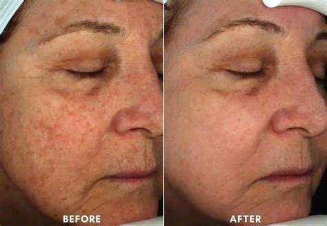 Laser Skin Resurfacing HALO BBL Hero Newtown Square PA